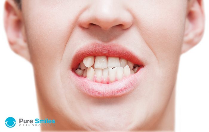 Our Austin Orthodontist Discusses Common Causes of Crooked Teeth
