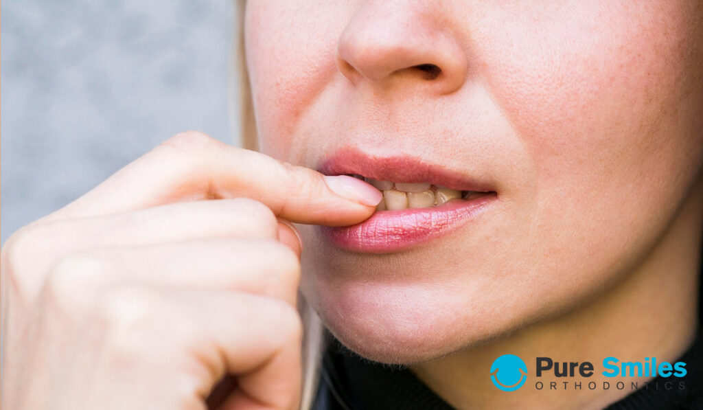 What to Know About Staining During Orthodontic Treatment