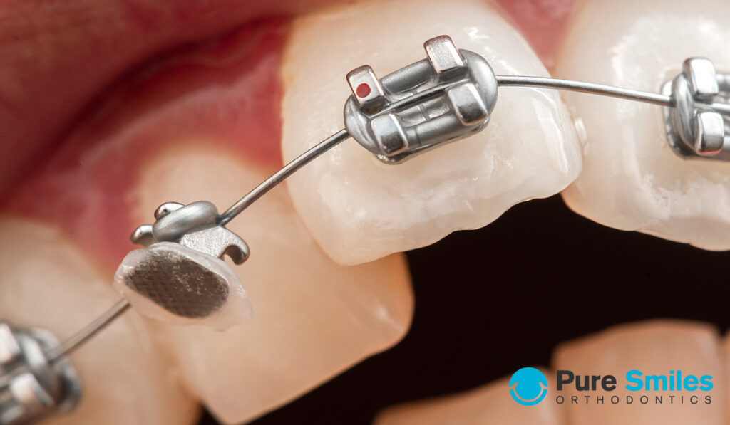 Tips for How to Navigate a Broken Bracket