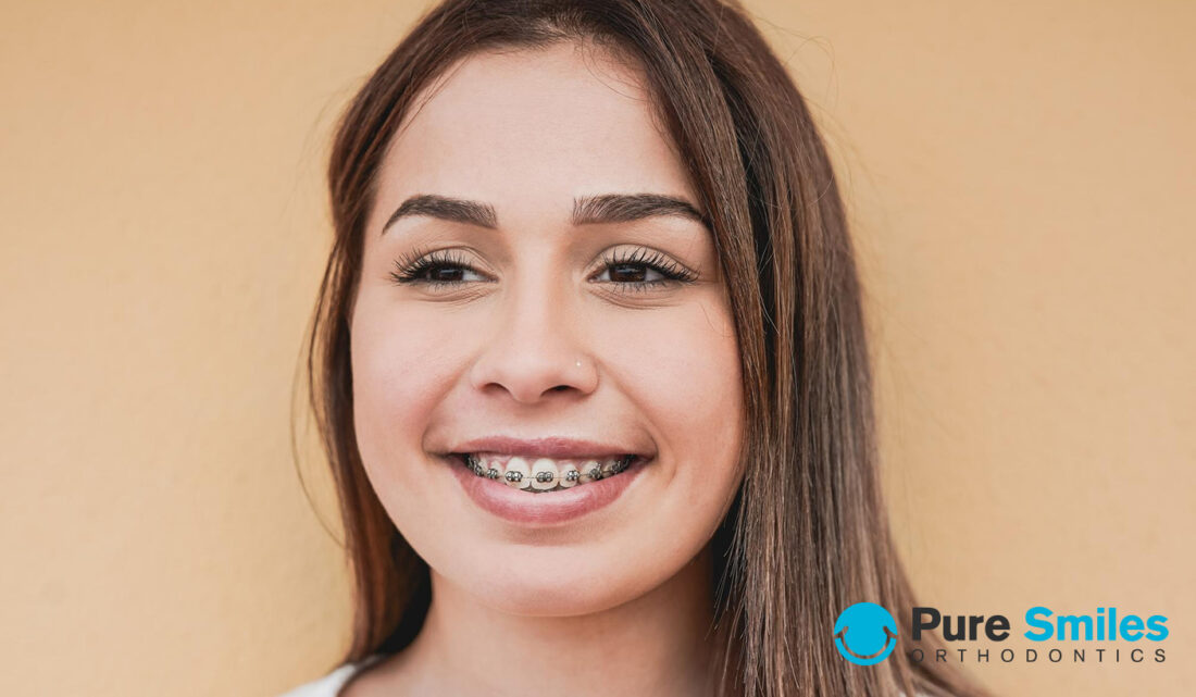 How Long Does the Average Orthodontic Patient Spend in Braces?