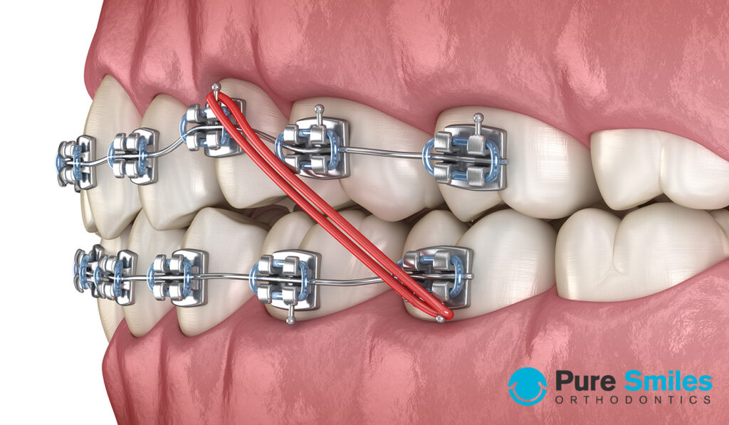 Are Rubber Bands Necessary For Orthodontic Treatment?