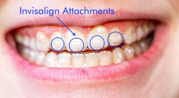 Invisalign Attachments Allow More Patients to Use the Treatment - Pure ...