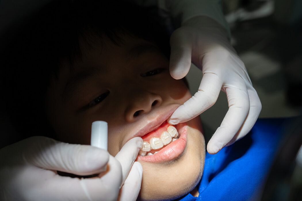 Invisalign Attachments Allow More Patients to Use the Treatment - Pure ...