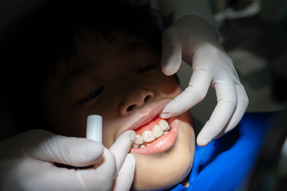 Invisalign Attachments Allow More Patients to Use the Treatment - Pure Smiles Orthodontics ...