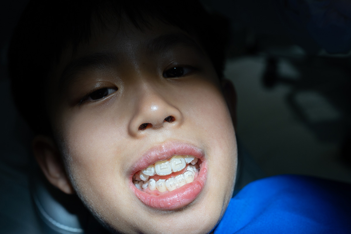 Invisalign Attachments Allow More Patients to Use the Treatment - Pure ...